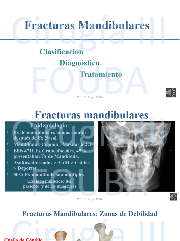 Fractura Mandibulares 2018 Campus | PDF | Cirugía | Ct Scan