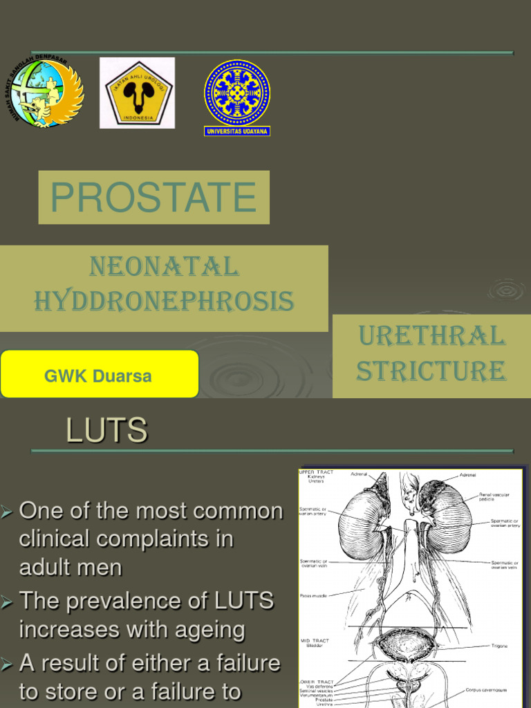 Lecture 15-16. BPH, Stricture Urethra, Varicocele, Spermatocele, Neonatal Hidronefrosis ...