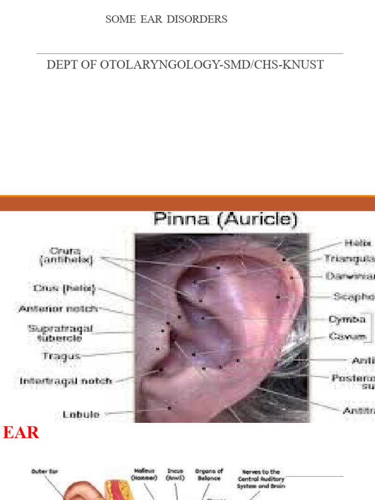 Some Ear Disorders | PDF | Tinnitus | Vertigo