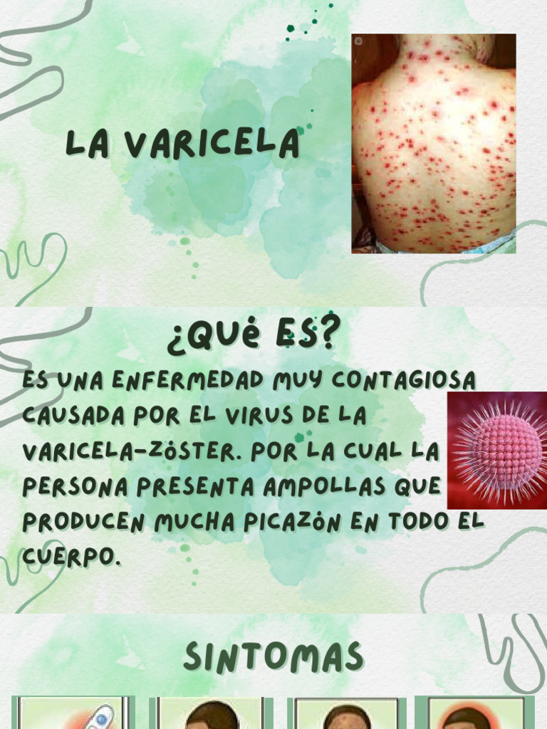 La Varicela | PDF