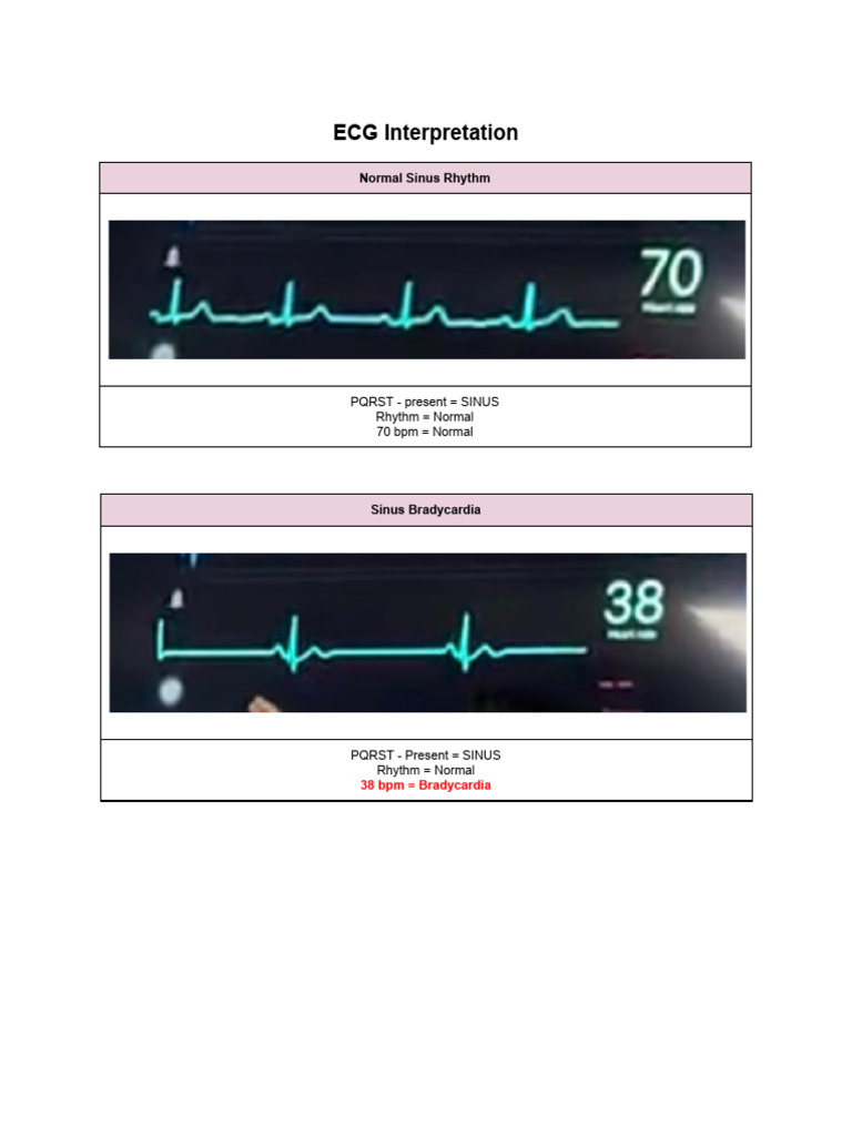 ECG Interpretation | PDF