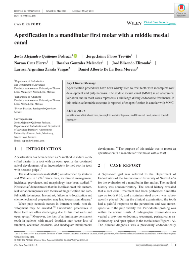 Apexification in A Mandibular First Molar With A M | PDF | Dental ...