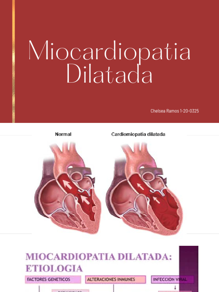 Miocardiopatia Dilatada | PDF