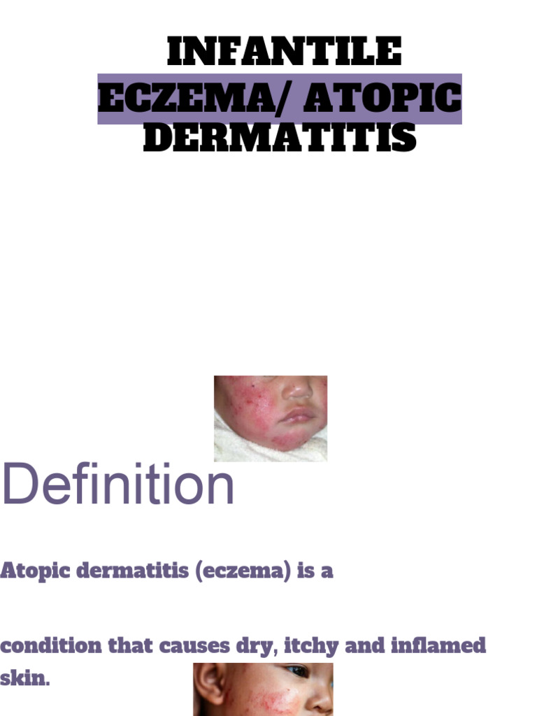 Eczema Atopic | PDF | Dermatitis | Topical Medication
