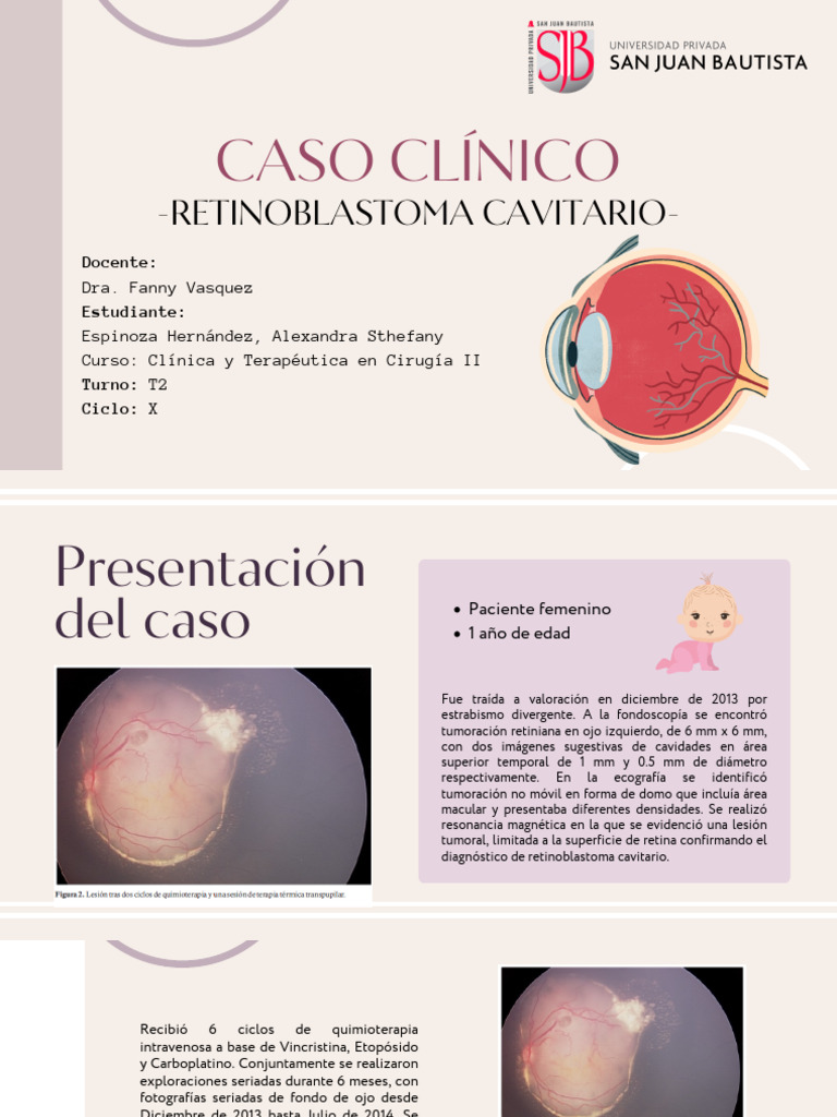 Caso Clínico de Retinoblastoma | PDF | Terapia | Cáncer