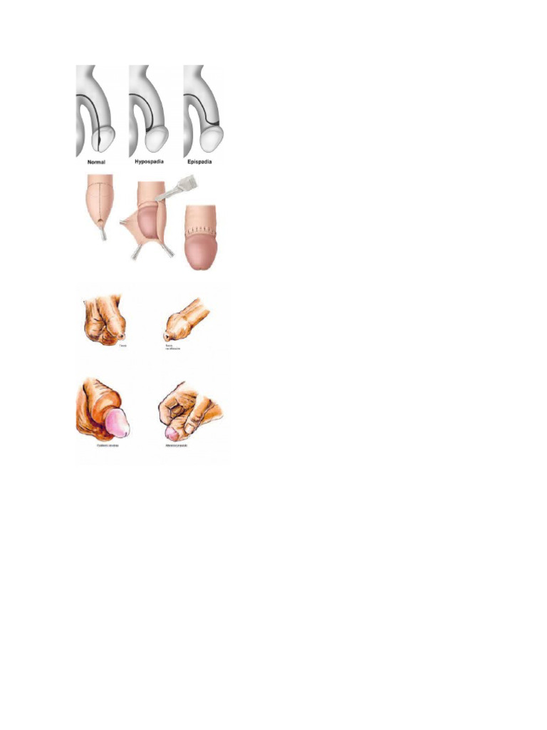 Epispadia y Más | PDF