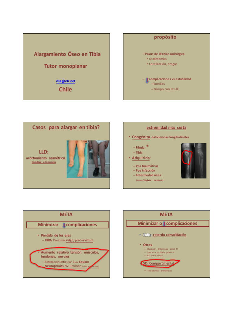 Chile: Alargamiento Óseo en Tibia | PDF | Sistema musculoesquelético