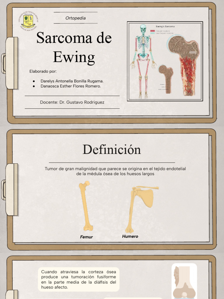 Sarcoma de Ewing: Diagnóstico y Tratamiento | PDF | Sarcoma | Hueso
