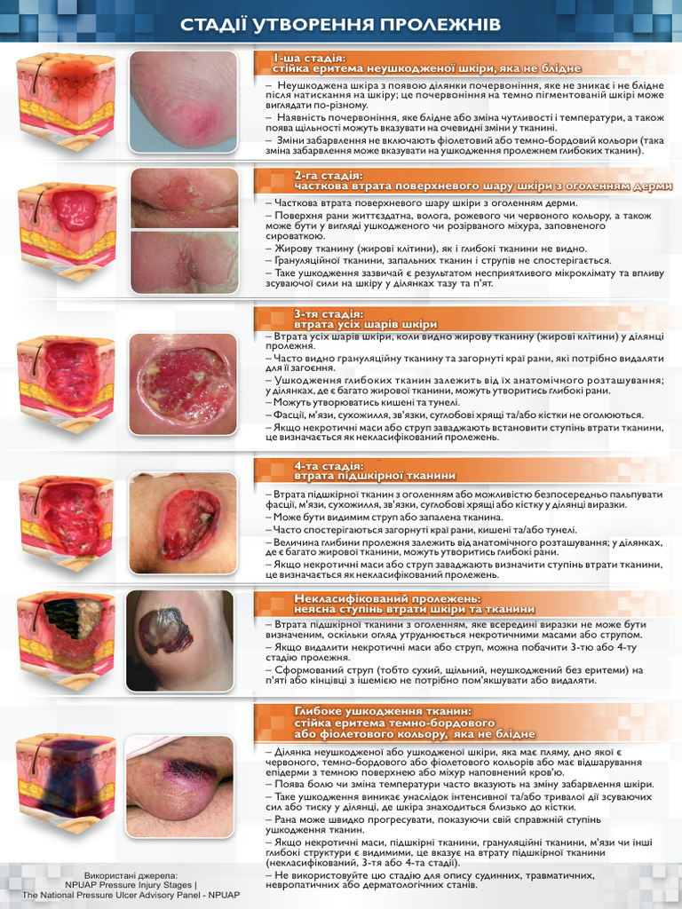 Stages of Pressure Sores 26-09-2019 | PDF