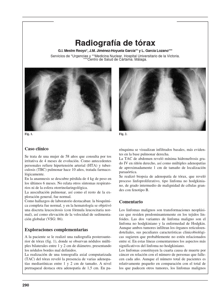Radiografía de Tórax: Caso Clínico | PDF | Linfoma | Cáncer
