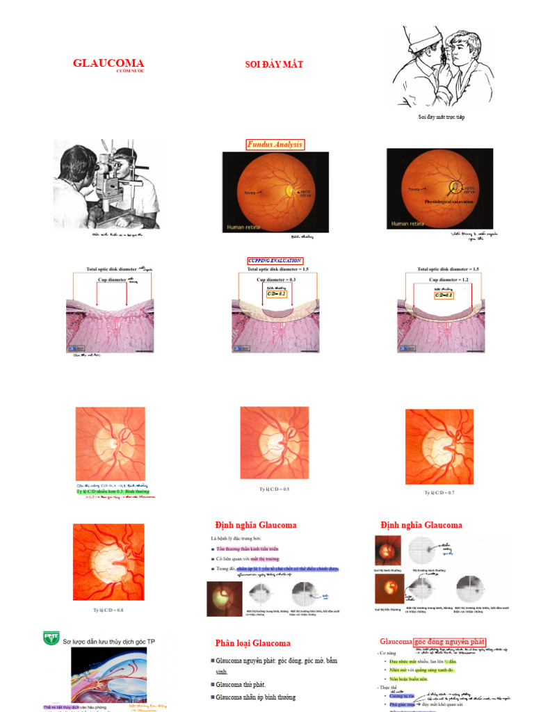 6.1-Glaucoma 2 | PDF