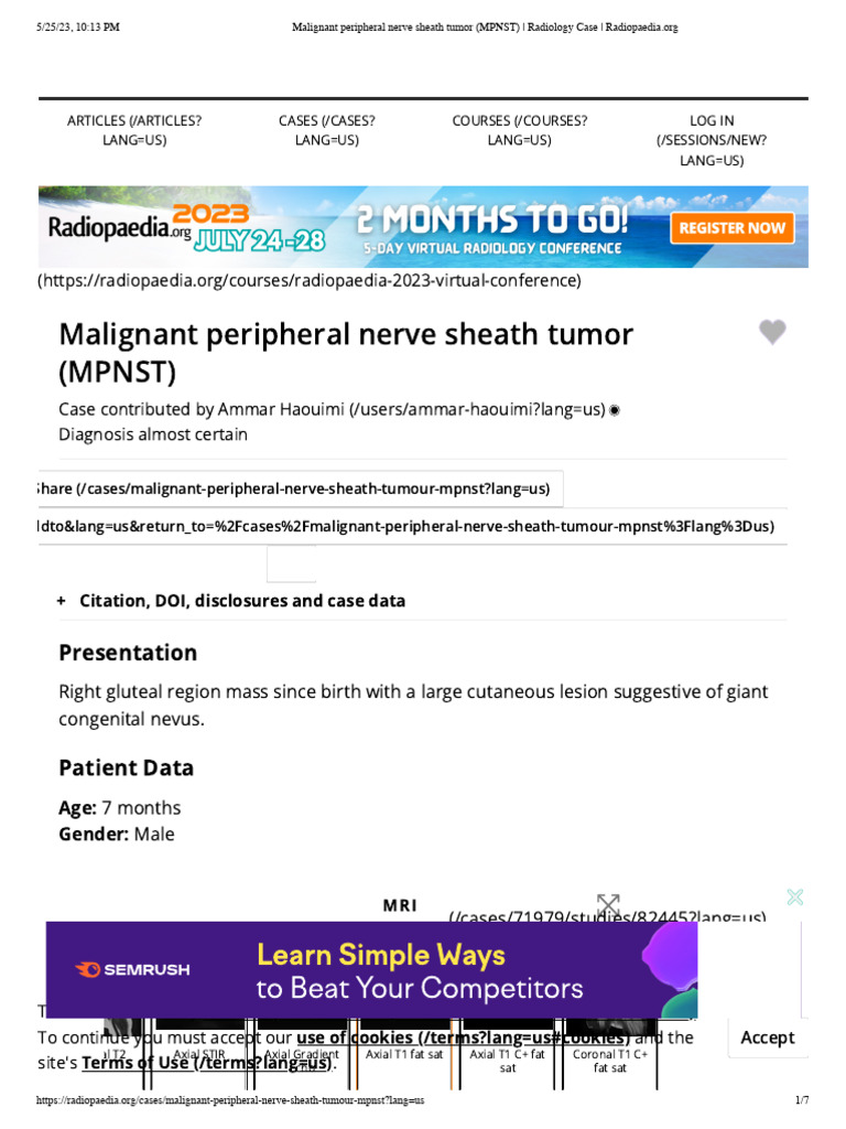 Malignant Peripheral Nerve Sheath Tumor (MPNST) - Radiology Case ...