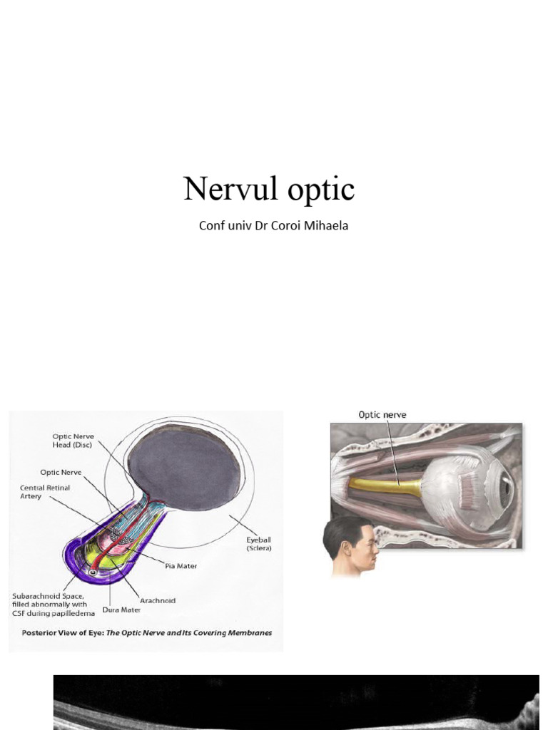 Prezentare Nervul Optic 1 | PDF