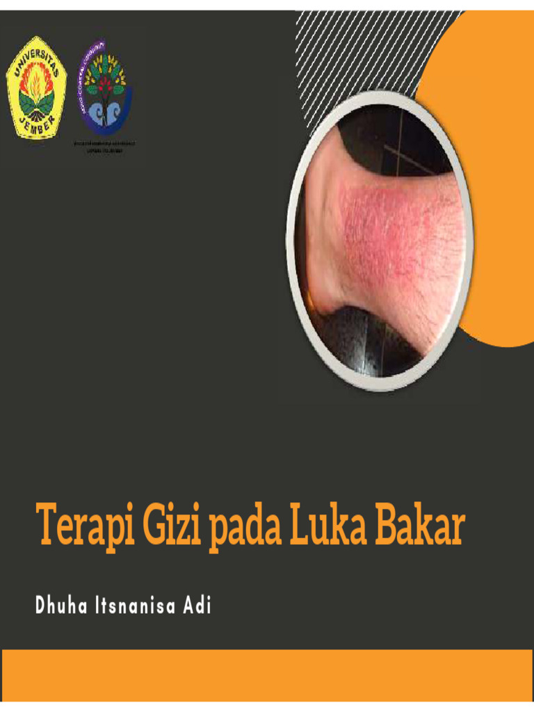 Terapi Gizi Pada Luka Bakar | PDF | Kesehatan Holistik