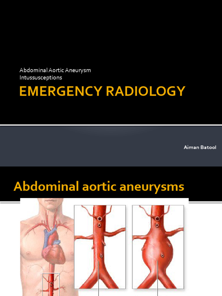 Emergency Radiology: Abdominal Aortic Aneurysm Intussusceptions | PDF ...