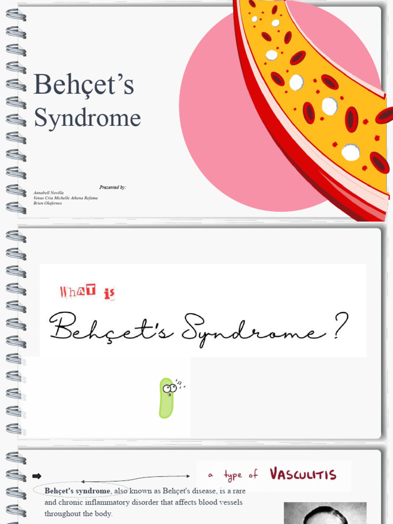 BEHCET'S Syndrome Wardclass FINAL | PDF | Inflammation | Immune System