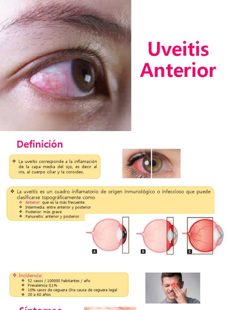 Uveitis Anterior | PDF | Ojo humano | Causas de la muerte