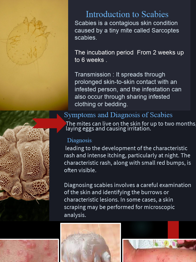 Introduction To Scabies | PDF | Clinical Medicine | Medical Specialties