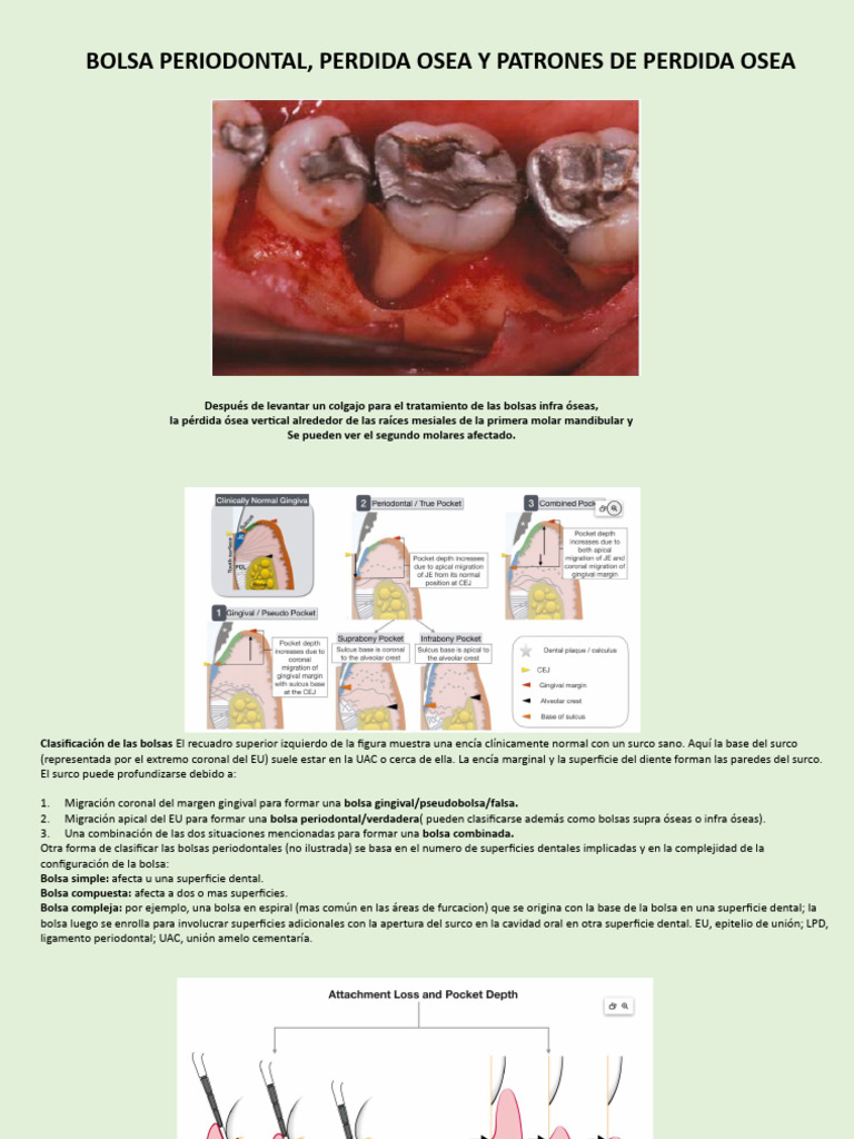 Clasificación de bolsas periodontales y pérdida ósea | PDF | Hueso ...