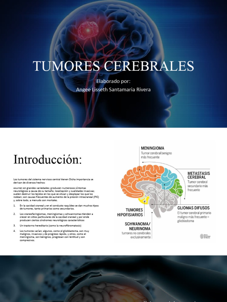 Tumores Cerebrales | PDF | Tumor cerebral | Glioma