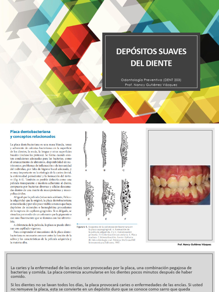 Depósitos Suaves Del Diente | PDF | Diente | Odontología