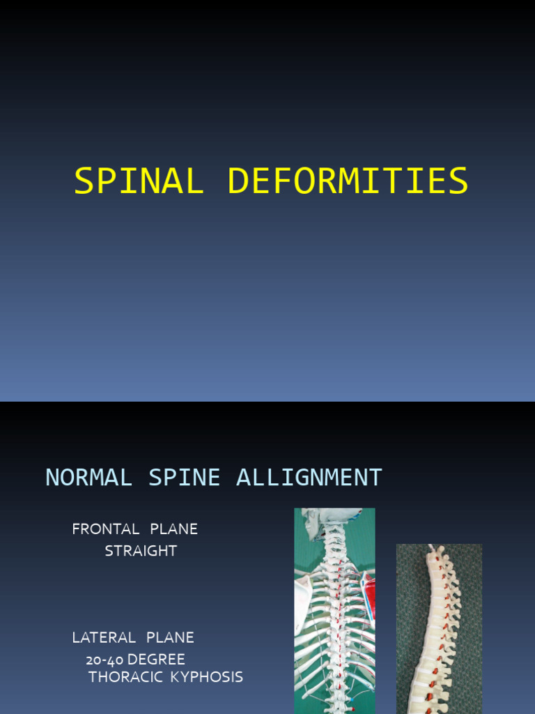 Spinal Deformities | PDF | Scoliosis | Vertebral Column