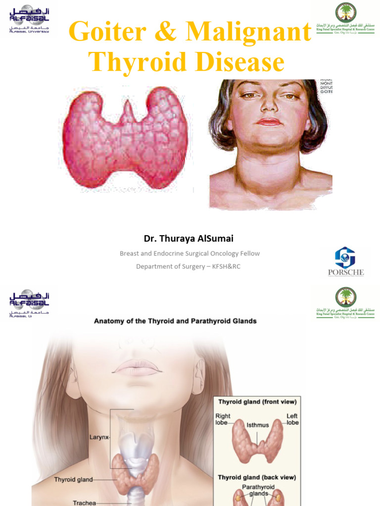 08. Goiter and Malignant Thyroid Disease | PDF | Thyroid | Thyroid Disease