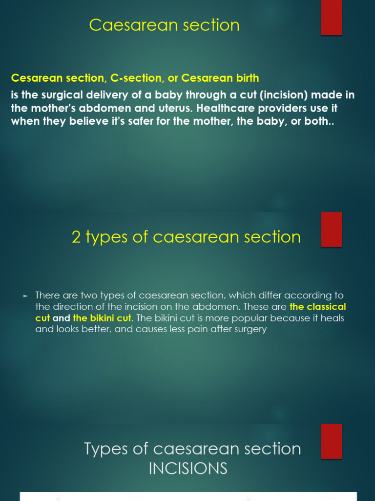 Caesarean section | PDF | Caesarean Section | Medicine