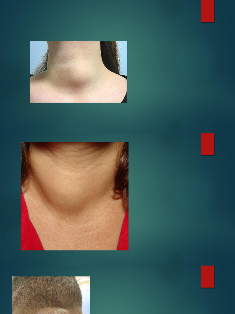 Midline Neck Swelling | Download Free PDF | Neck | Thyroid