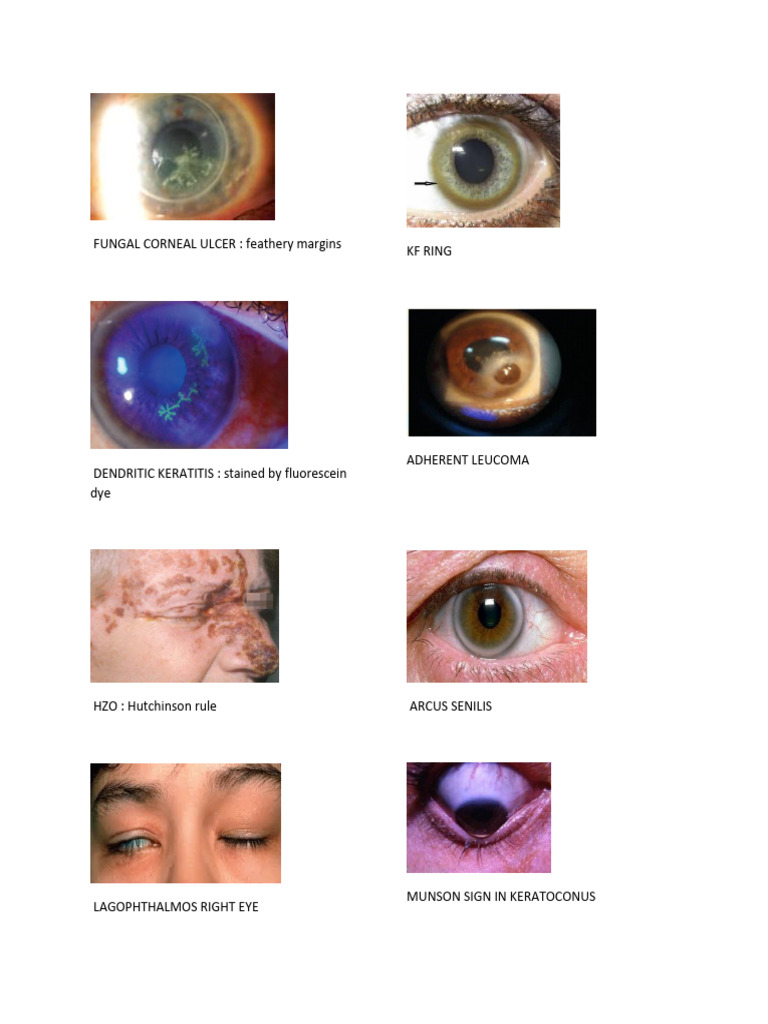 FUNGAL CORNEAL ULCER: Feathery Margins KF Ring | PDF | Glaucoma | Cornea