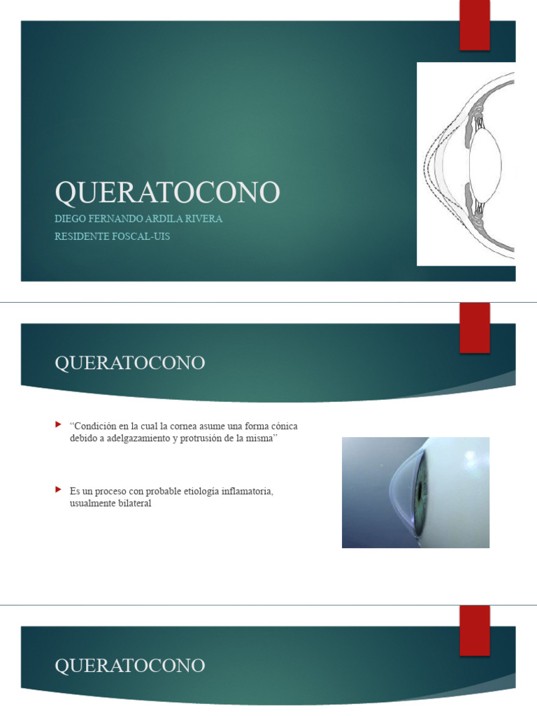 QUERATOCONO | Descargar gratis PDF | Oftalmología | Visión