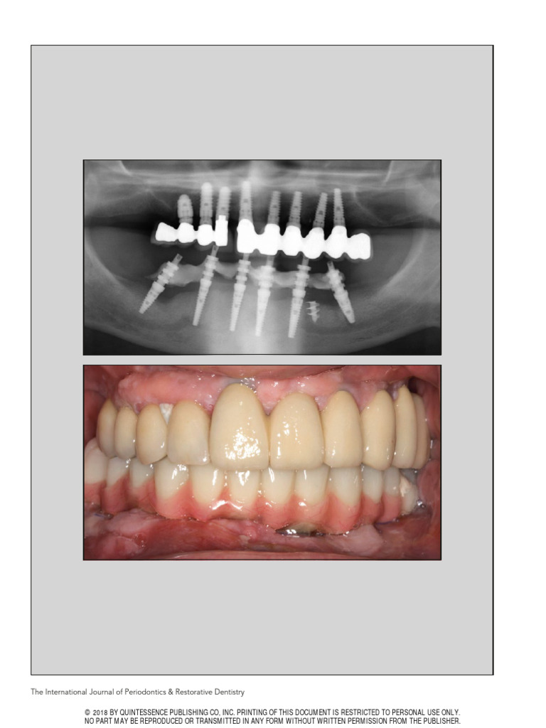 Double Duplicate Technique For Cad Cam Full Arch Immediate Loading A ...