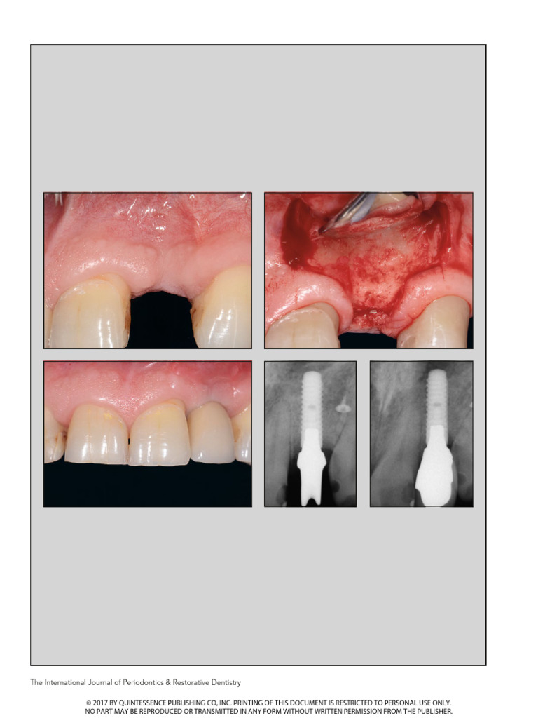 Incision Design and Soft Tissue Mangement To Maintain or Establish An ...