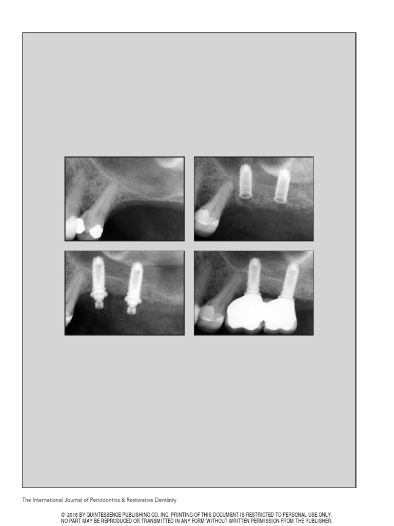 Three-Dimensional Bone Augmentation and Immediate Implant Placement Via ... Three-Dimensional Bone Augmentation and Immediate Implant Placement Via ...