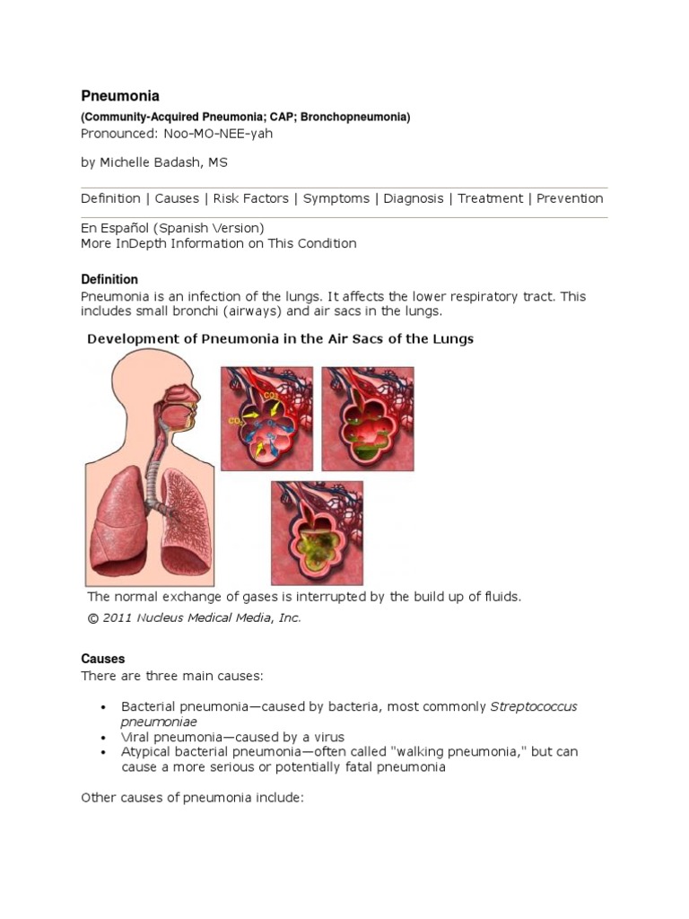 Pneumonia | Pneumonia | Infection