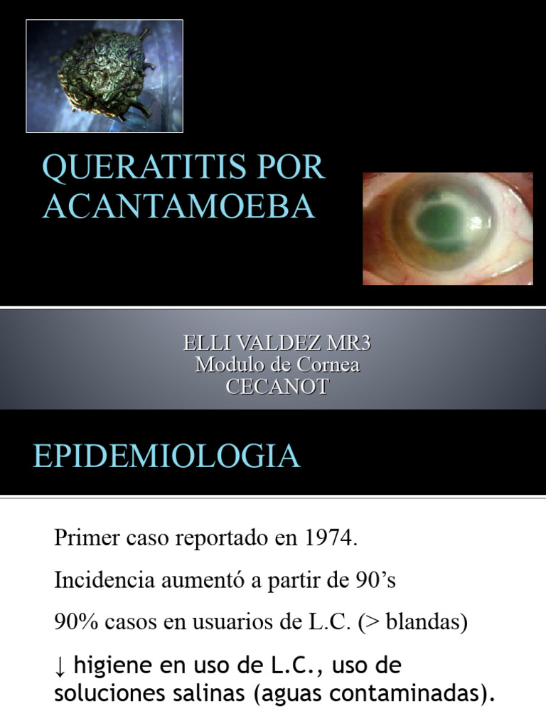Queratitis Por Acanta Elli | Descargar gratis PDF | Corticosteroides ...
