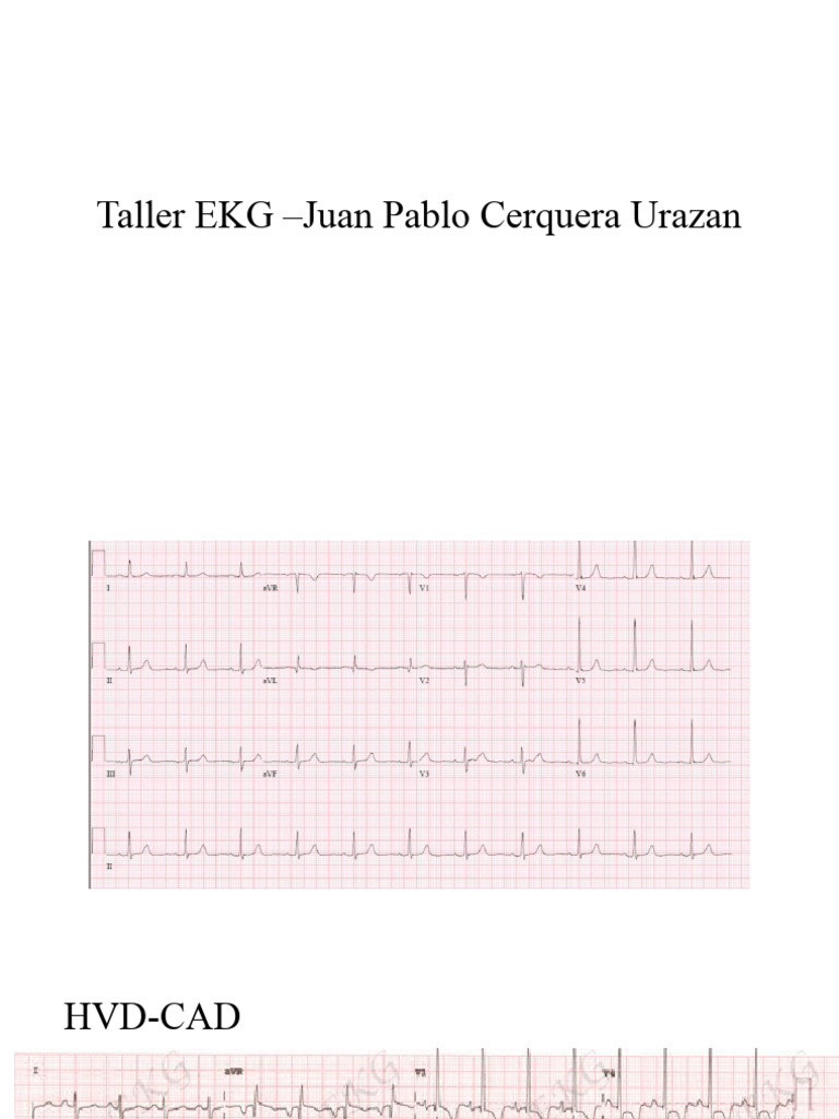 Taller EKG - Juan Pablo Cerquera Urazan | PDF
