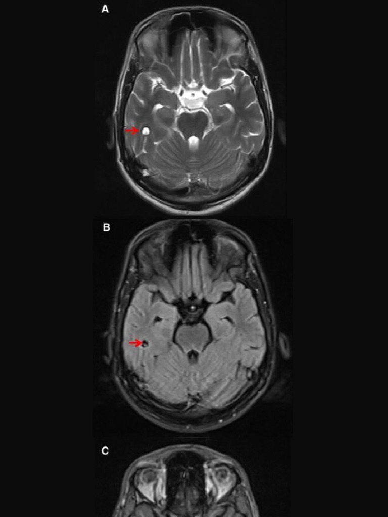 MRI of Neurocysticercosis | PDF