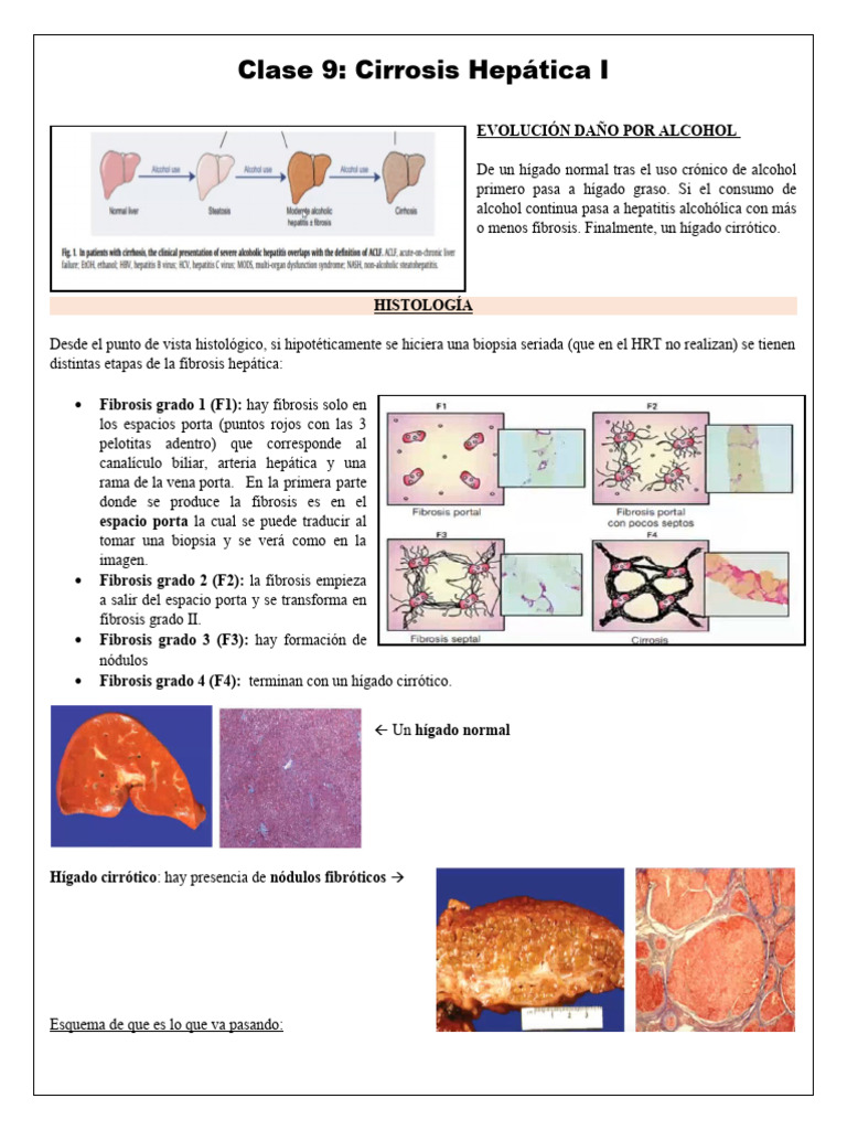 Cirrosis Hepática Parte 1 | PDF | Cirrosis | Hepatitis