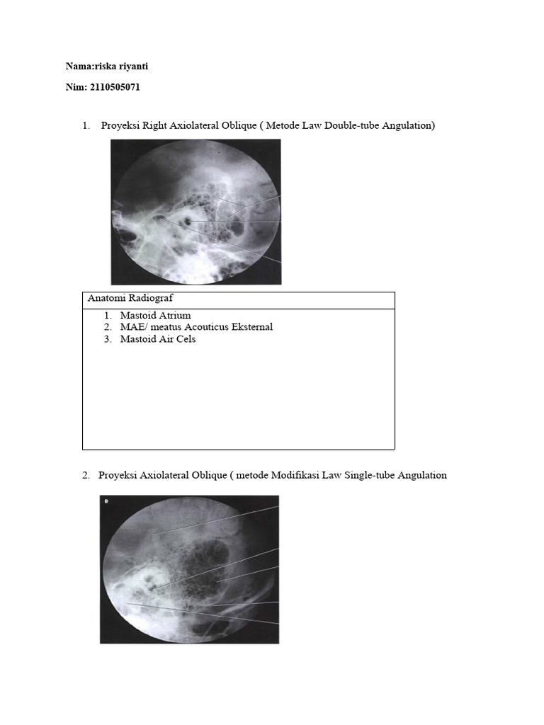 71 - Riska Riyanti (Mastoid Dan Petrosum) | PDF