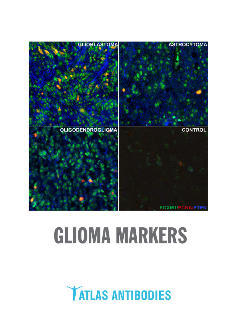 Glioma Markers | PDF | Glioma | Brain Tumor