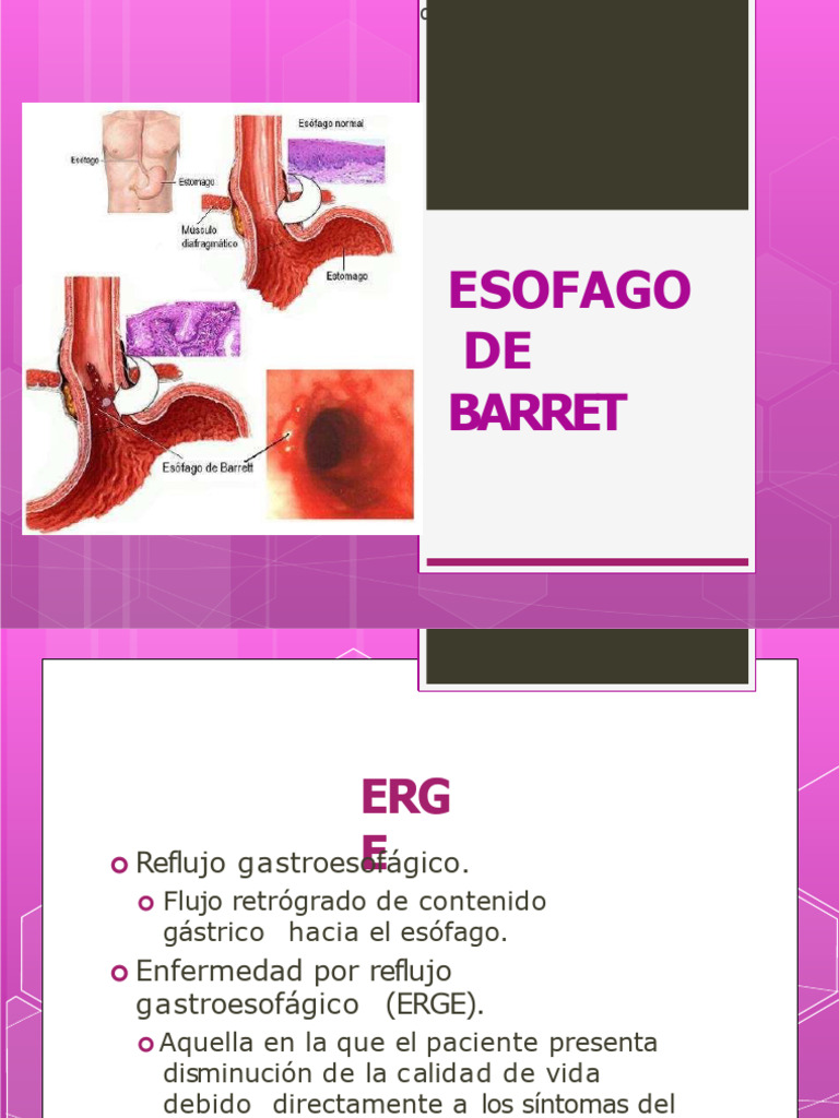 Esofago de Barret | Descargar gratis PDF | La enfermedad por reflujo ...