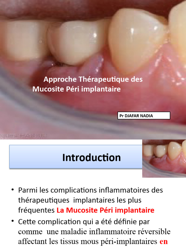 Approches Thérapeutiques Mucosite Péri-Implantaire | PDF | Implant ...