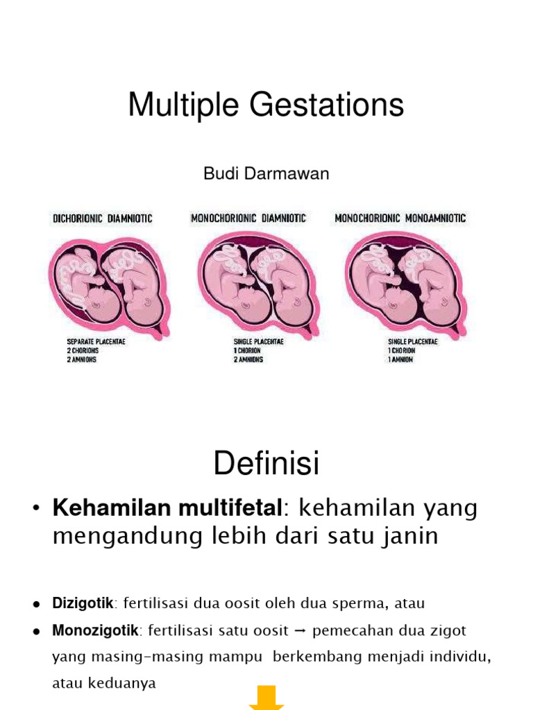 3 - Multiple Gestations | PDF | Kesehatan Holistik