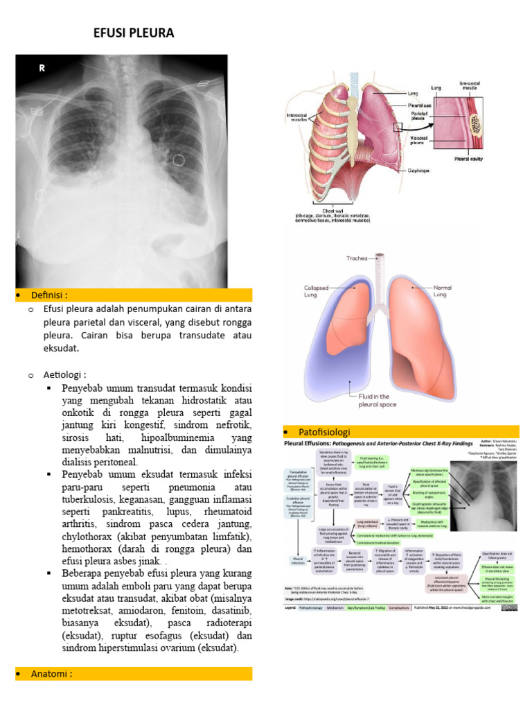 Efusi Pleura | PDF