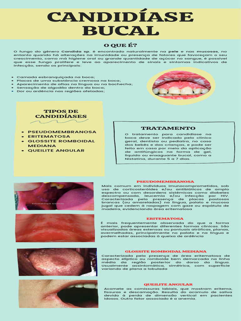 Candidíase Oral | Download grátis PDF | Candidíase | Boca