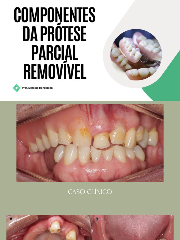 Constituintes Da PPR | PDF | Dente humano | Prótese