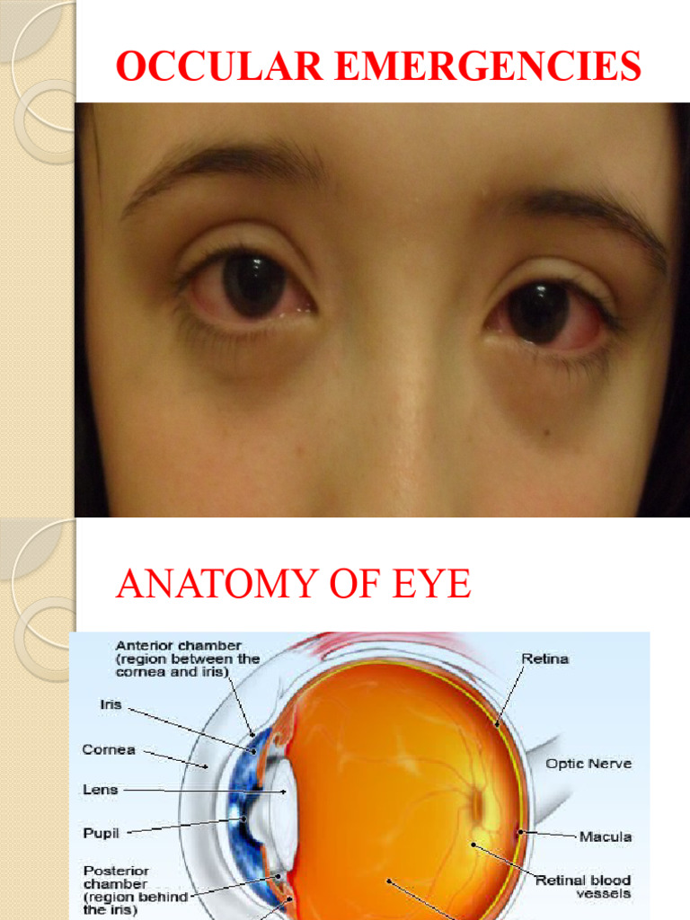 Occular Emerg PPT 1 | PDF | Glaucoma | Cornea