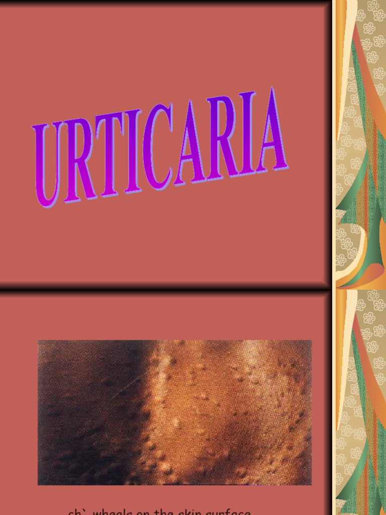 Urticaria | PDF