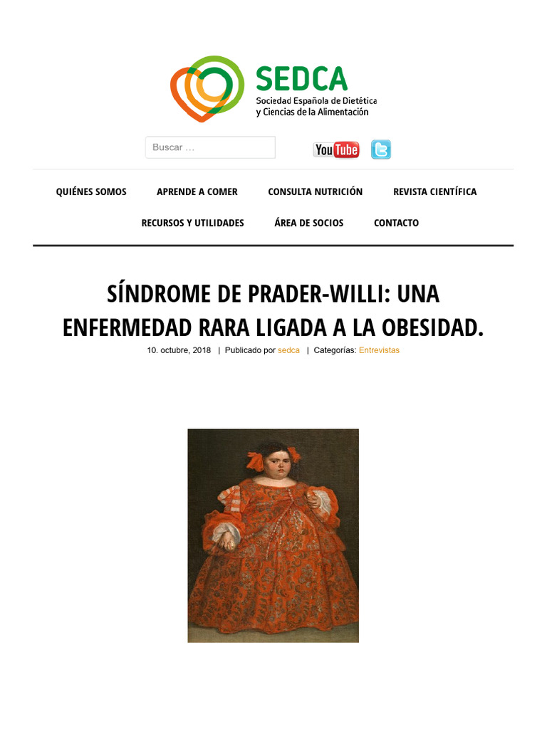 Síndrome de Prader-Willi Una Enfermedad Rara Ligada A La Obesidad ...